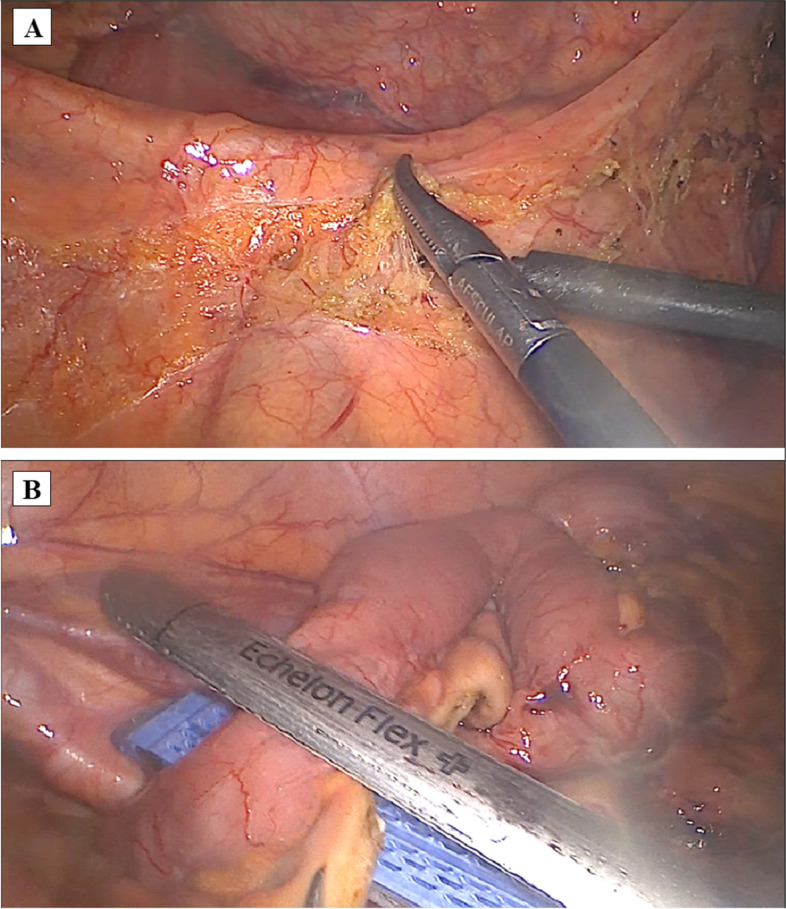 Bach Mai Procedure for complete mesocolic excision, central vascular ligation, and D3 ...