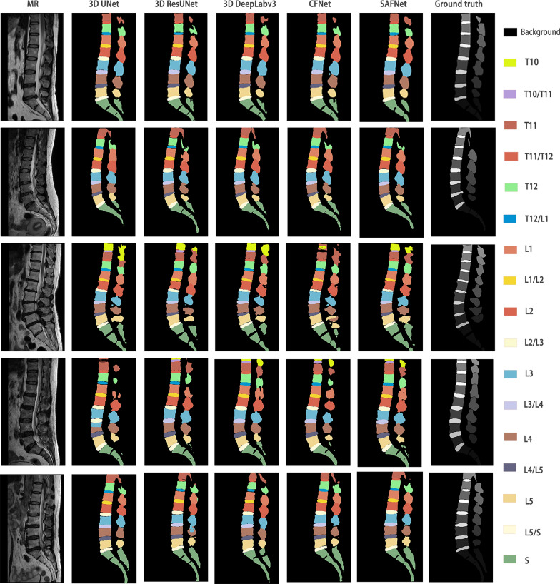 A spine segmentation method based on scene aware fusion network - PMC