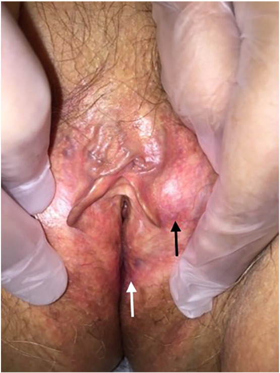 Vulvar lichen planus pemphigoides - PMC